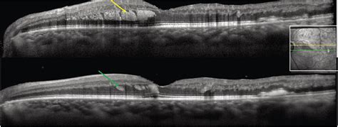 Can You Recognize These Novel Oct Signs