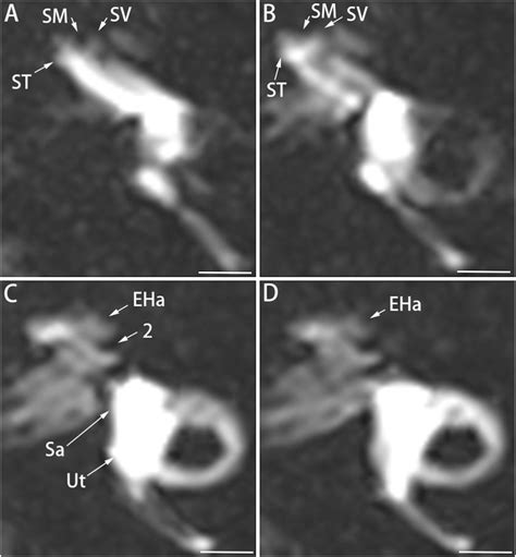 Representative Mri In Patients With Md Displaying Cochlear Download Scientific Diagram