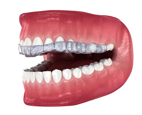Upper Occlusal Splints Tmj