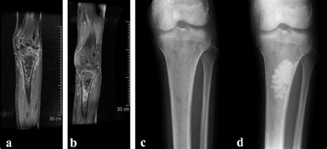 Mri Of The Proximal Tibia Showing Bilateral Osteonecrosis And Soft