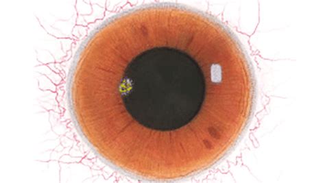 Efron Grading Scales Coopervision Australia