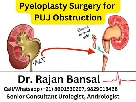 Anderson Hynes Pyeloplasty Surgery For Puj Obstruction