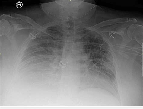 Chest X Ray On Presentation Anterior Posterior Ap View Showing