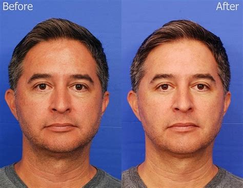 Blepharoplasty Thirteen — Sky Facial Plastic Surgery