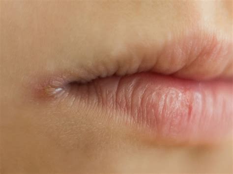 How Do You Heal Cracked Corners Of Your Mouth