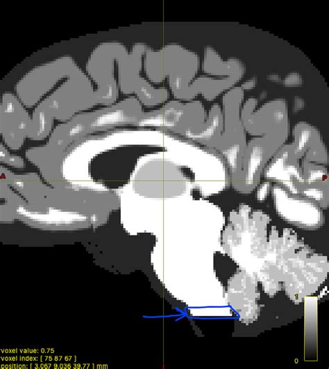 Automatically Defining Spinal Cord Roi For Custom Parcellation Tractography Mrtrix3 Community