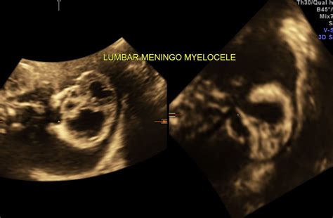 Meningo Myelocele 3 D And 4 D Images Looking Through A Transducer