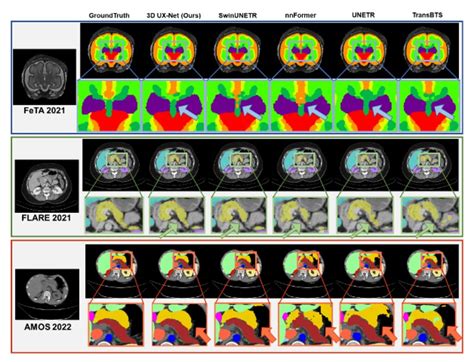 visualizing different case support 3d slicer community