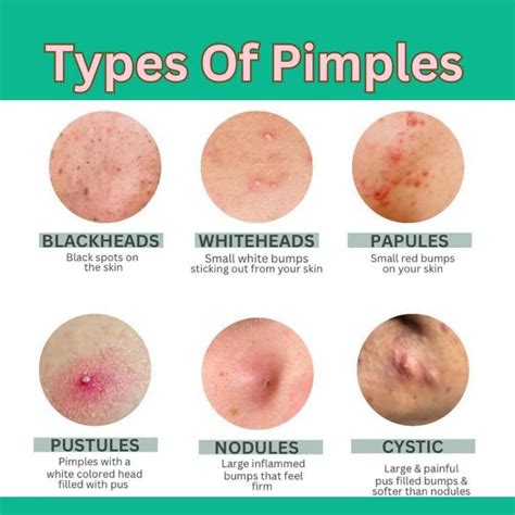 When Can You Pop A Pimple 3 Signs You Can Pop It Natural Skin Guides
