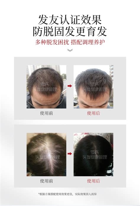 罗缔·发域 防脱液
