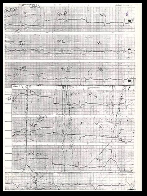 B Technically Very Poor Quality Ecg Of The Same Patient In A Showing