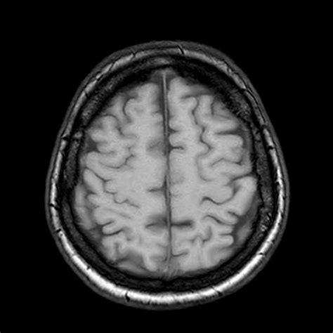Brain Mri Multiple Sclerosis Dataset Kaggle