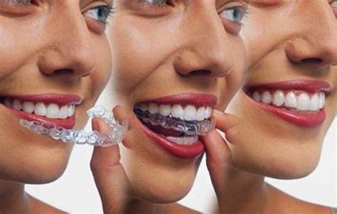 Top 6 Các Loại Niềng Răng Trong Suốt Phổ Biến ⚡️ Lưu Ý Khi Niềng