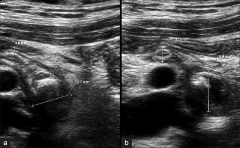 Pin On Appedicitis Omental Infarction