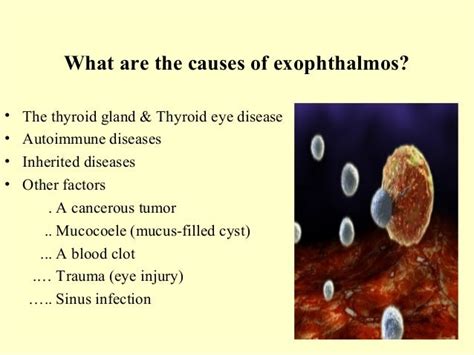 Exophthalmos Thyroid Eye Disease