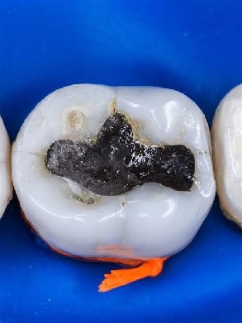 Composite Fillings 4 Common Advantages And Disadvantages World Of
