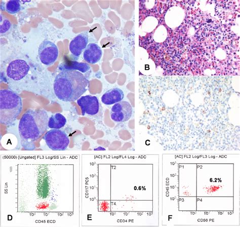 A The Bone Marrow Aspirate Showed Increased Blasts Ranged In Size With