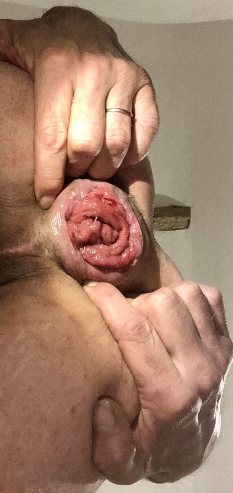 Anal Dilation After Big Insertion 29 Pics Xhamster