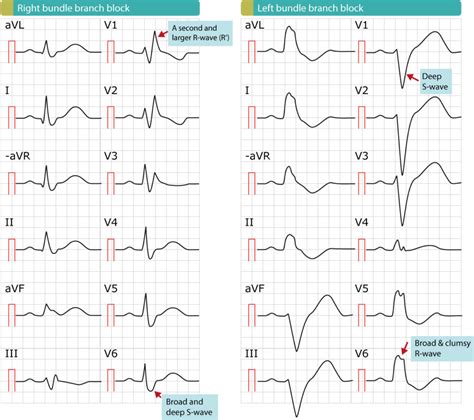 Right Bundle Branch Block Rbbb Ecg Criteria Definitions Causes And Treatment
