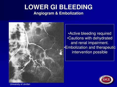 Lower Gi Bleeding Causes Ppt Download