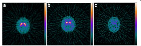 Dat Scan Examples Dat Scan Transaxial Spect Sections For A A