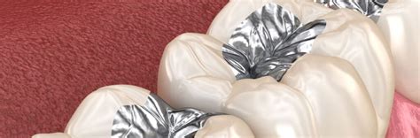 Amalgam Filling Galata Poliklinik