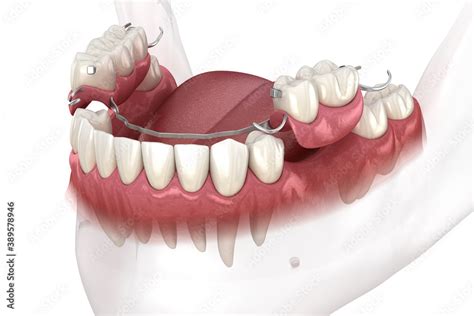 Removable Partial Denture Mandibular Prosthesis Medically Accurate 3d
