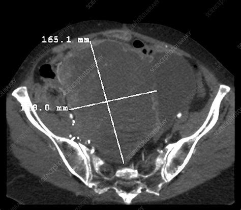 Pelvic Tumour Ct Scan Stock Image C057 8407 Science Photo Library