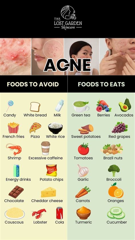 Acne Foods To Avoid And Food To Eat Foods For Clear Skin Clear Skin