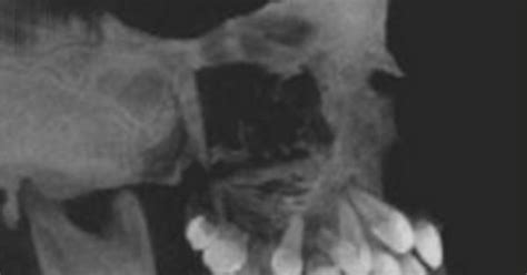 Hyperdontia Album On Imgur