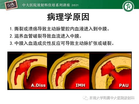中大放射住培系列讲座急性主动脉综合征CT危险征象识别 放射科