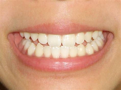 前歯の治療！保険がきかないものときくものの違いを解説！ チェスナッツロード