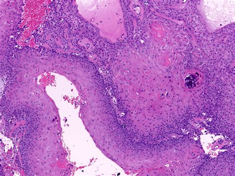 Pilar Cyst Histology
