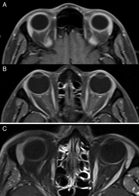 Trigeminal Autonomic Cephalgia Caused By Recurrent Posterior Scleritis