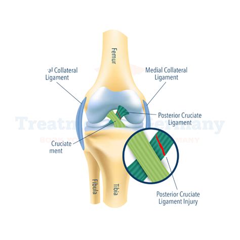 Professional Help For Pcl Recovery In Germany