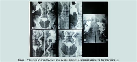Figure 1 From Pelvic And Abdominal Lipomatosis A Rare Case Report