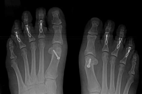 Most Popular Hammertoe Devices And Implants In The U S