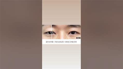 에스원성형외과 절개 쌍꺼풀 속쌍 눈매교정 앞트임 수술 3개월 전후 절개쌍꺼풀 앞트임복원 앞트임 앞트임재수술 눈매교정