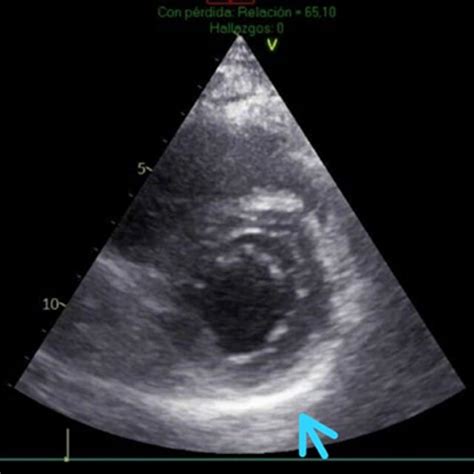 Echocardiogram Of The Short Axis With Thickening Of The Parietal