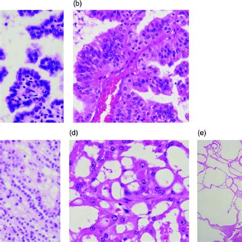 Chromophobe Rcc And Oncocytoma A Chromophobe Rcc Representative