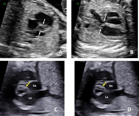 🚨new Article🚨 Diagnostic Value Of Selected Fetal Echocardiographic