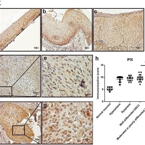 Characteristic Ifix Expression In Oscc And Its Precursor Stages Ac