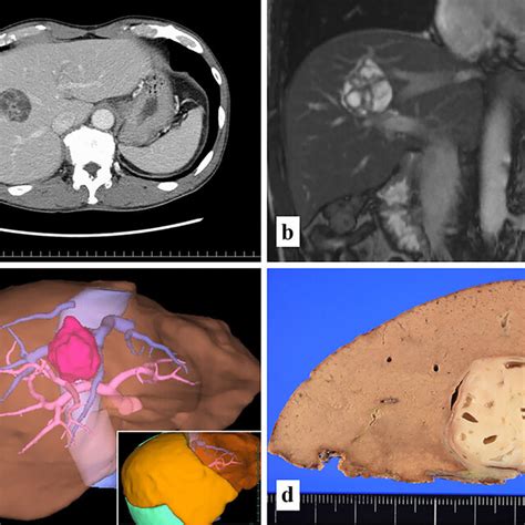 A Delayed Arterial Phase Of Dynamic Ct A Well Demarcated Multicystic