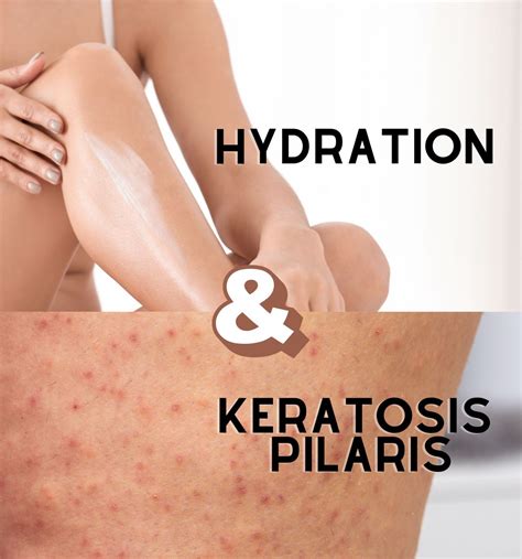 Keratosis Pilaris Before And After
