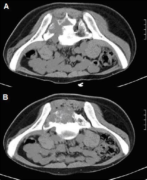 Ewing Sarcoma Mri