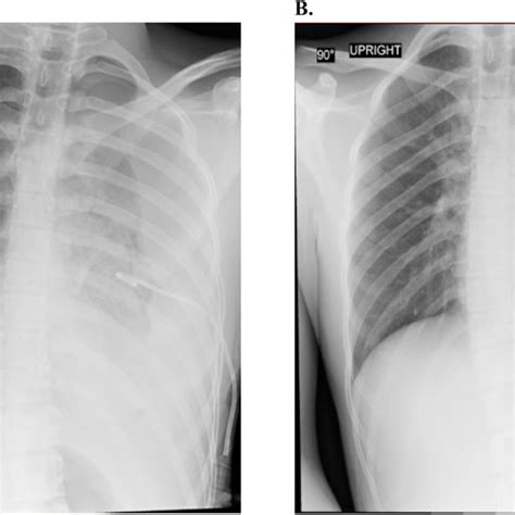 Ct Image Of Hemopneumothorax Download Scientific Diagram