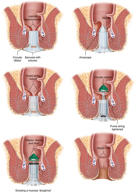 Hemorrhoids Springerlink
