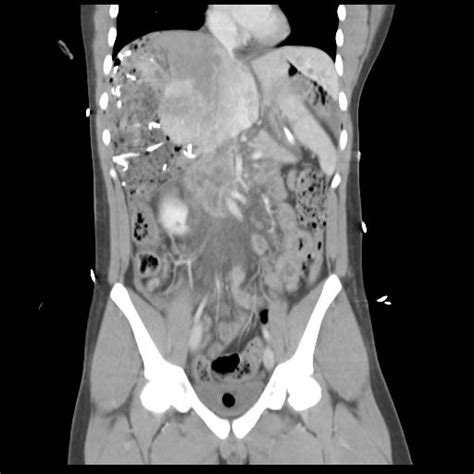 File Hepatic Renal And Adrenal Devascularisation In A Multi Trauma