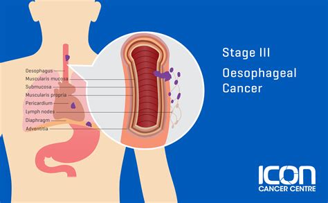 Oesophageal Cancer Explained Icon Oncology Malaysia