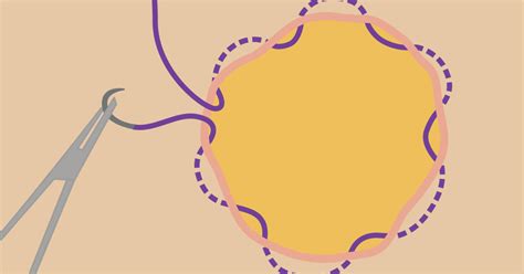Purse String Skin Closure For Stoma Reversal Evidence Of Practice